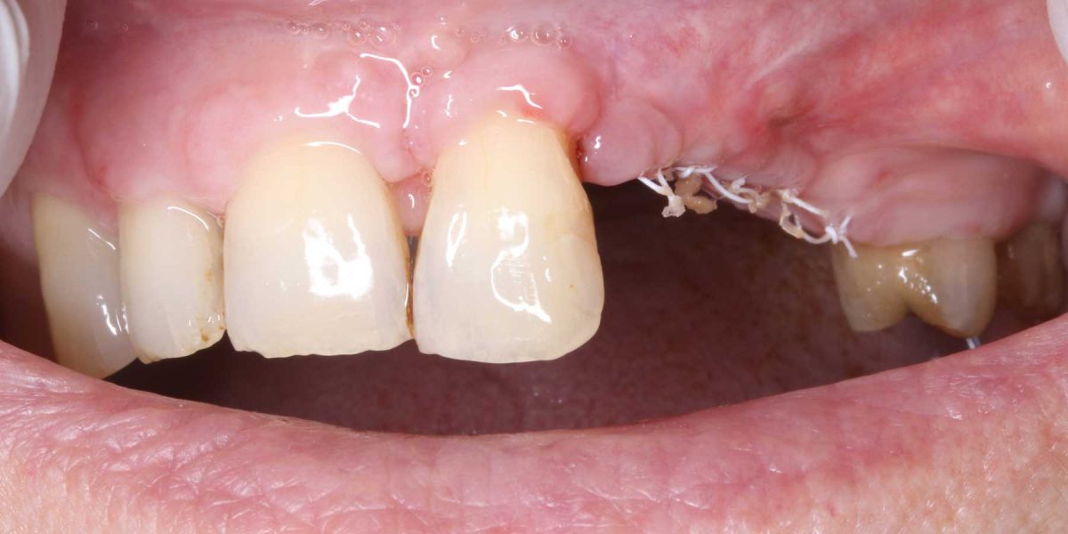 Caso complejo de regeneración ósea vertical - Rubal Dental
