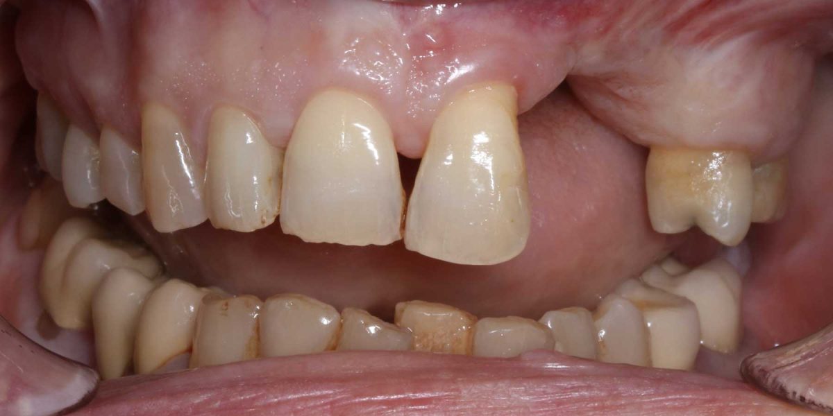 Caso complejo de regeneración ósea vertical - Rubal Dental