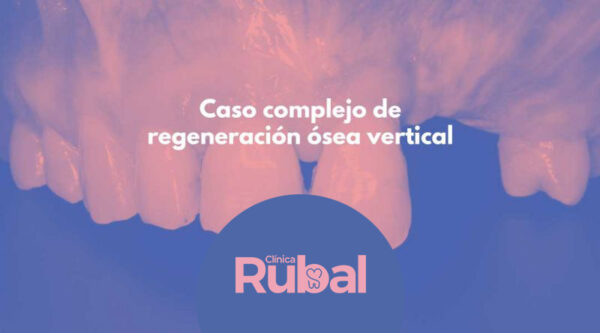 Caso complejo de regeneración ósea vertical - Rubal Dental
