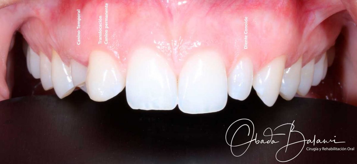 Falta de diente permanente y transposición de colmillo