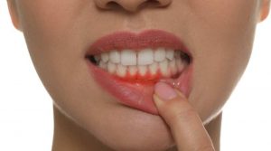 Estomatitis: Qué es, tipos, causas y tratamiento ¡Descúbrelo aquí!