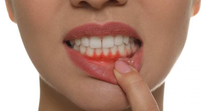 Estomatitis: Qué es, tipos, causas y tratamiento ¡Descúbrelo aquí!