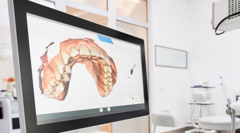 Ventajas del Escáner Intraoral 3D: precisión, comodidad y rapidez