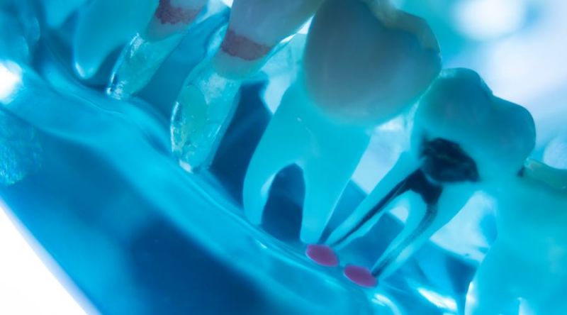 Infección dental: síntomas y tratamiento de un diente infectado
