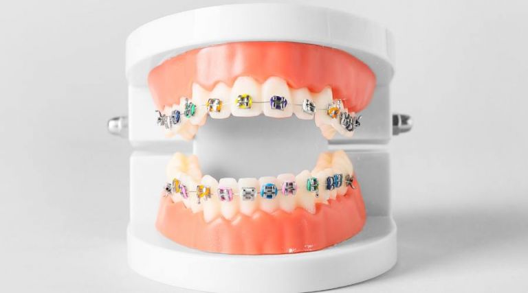 Partes de un bracket: conoce todas sus piezas