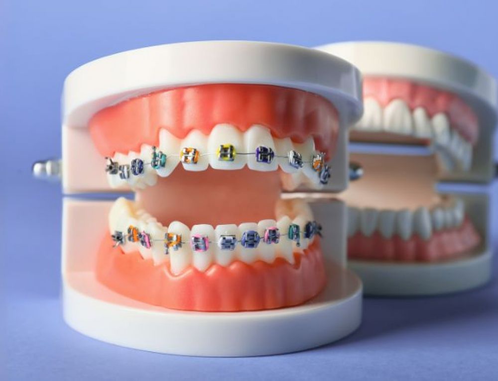 Partes de un bracket: conoce todas sus piezas